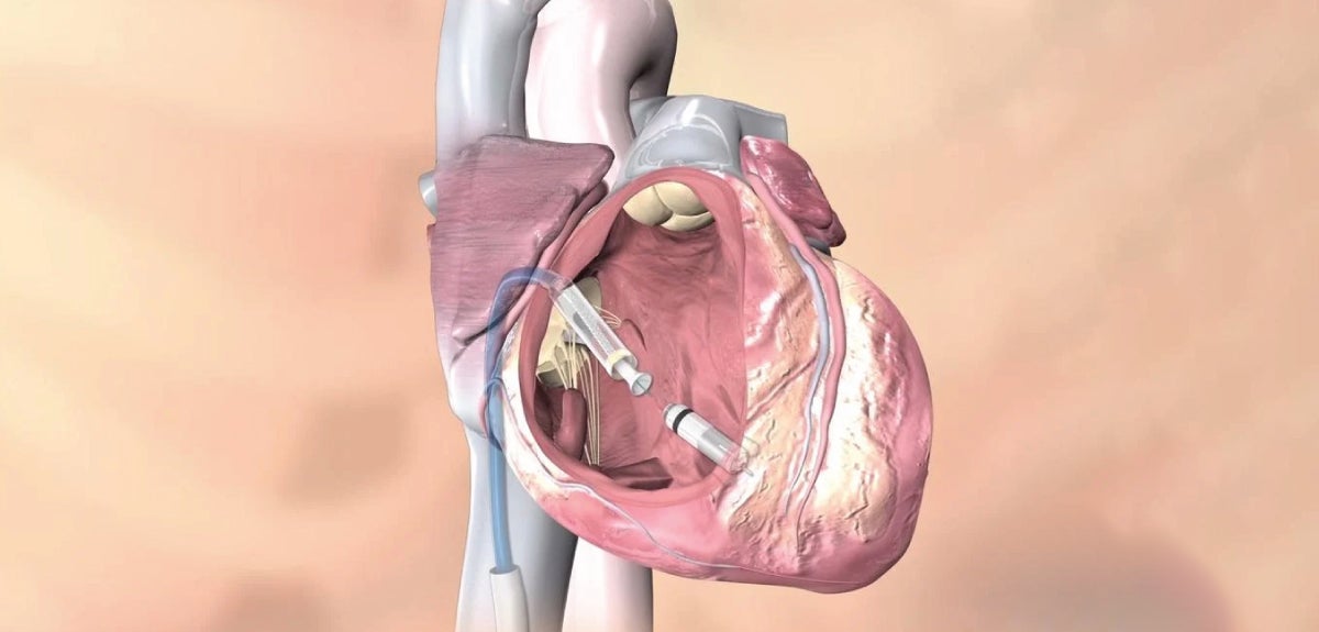 Micra Leadless Pacemaker | Saint Agnes Medical Center